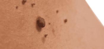 What is Skin Tag Removal Wigan